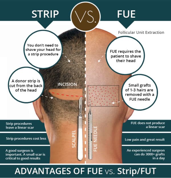 FUE Vs. FUT: Which Hair Transplant Methods Is Right For You?